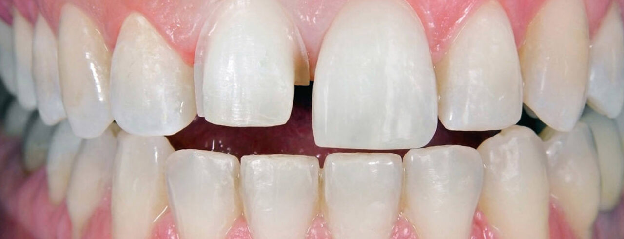 How to treat gaps between teeth